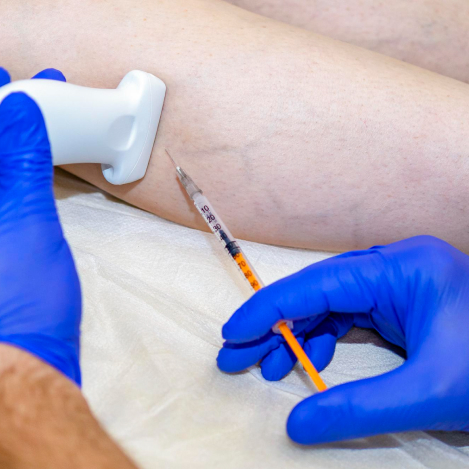 Varicose Veins Treatment – Clinica Ramita